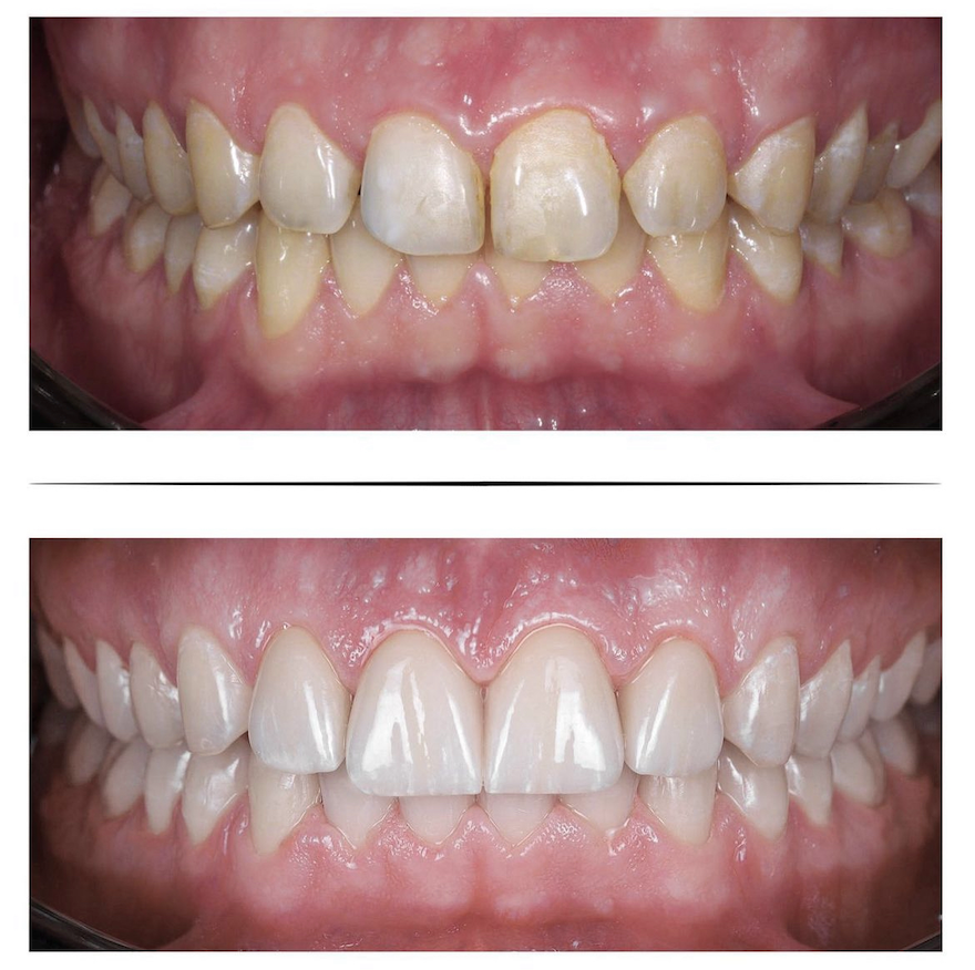 Composite Veneers Pros And Cons